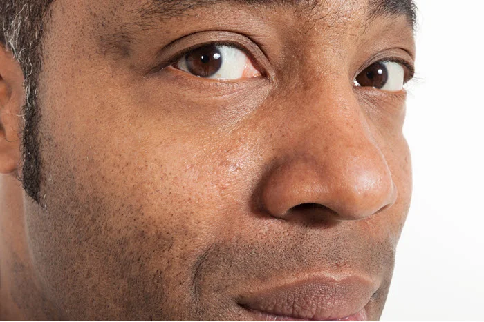 Disease & Conditions - Prostate Cancer: Causes, Symptoms, Diagnosis ... Disease & Conditions - Prostate Cancer: Causes, Symptoms, Diagnosis ...